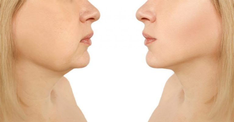 Liposuction | Dr. Nauman Gill | Asthetic Plastic Surgeon